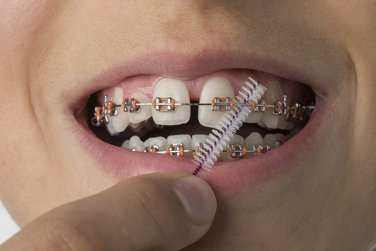 Before And After Braces Gaps