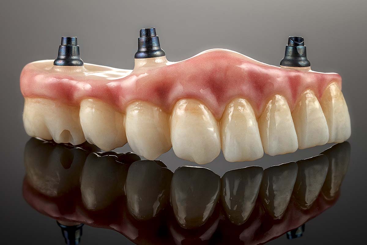 What Are Overdentures? | Dentaleh